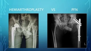 Hemiarthoplasty debate. hemiarthroplasty | PPT