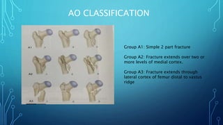 Hemiarthoplasty debate. hemiarthroplasty | PPTX