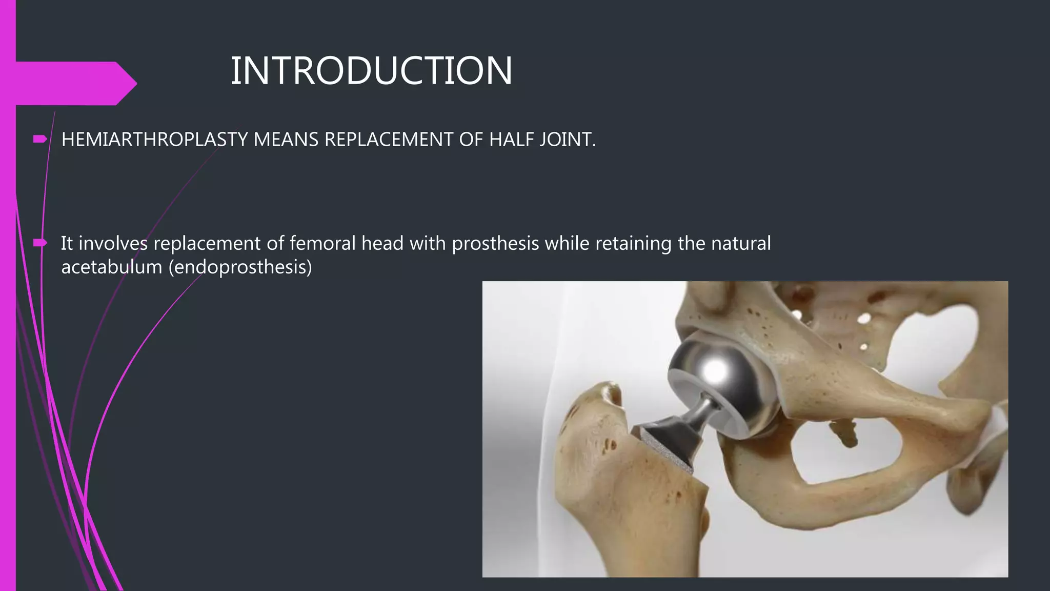 Hemiarthroplasty | PPTX