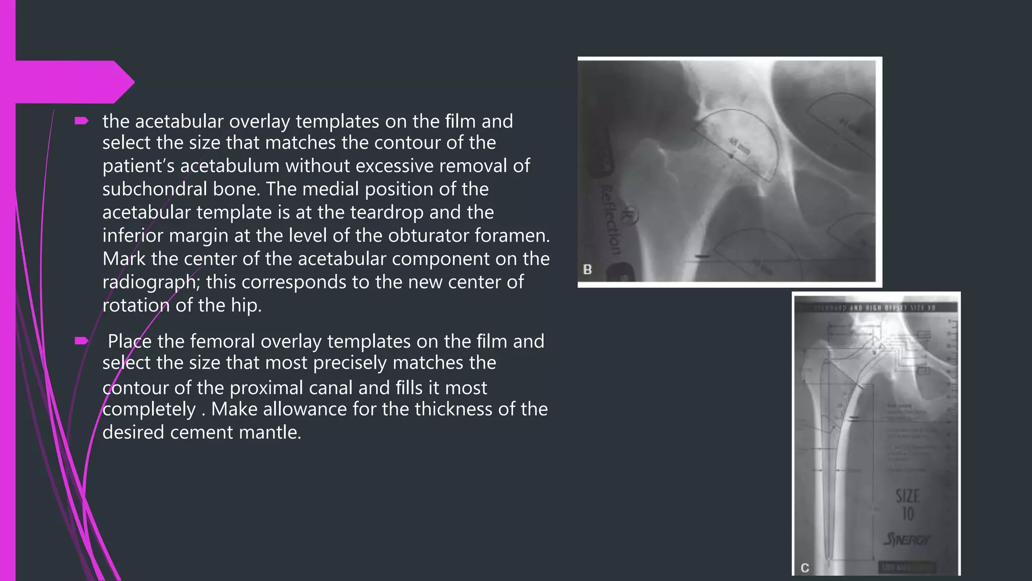 Hemiarthroplasty | PPTX