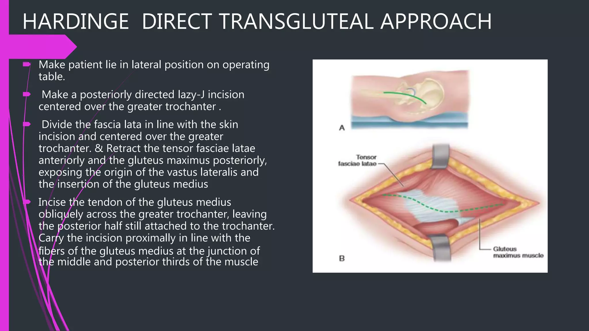 Hemiarthroplasty | PPTX