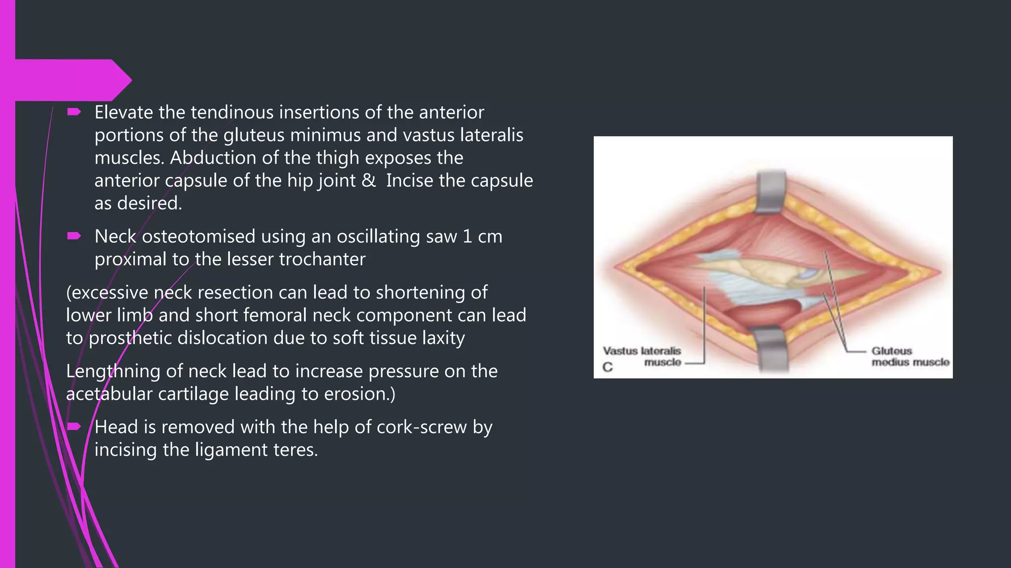 Hemiarthroplasty | PPTX