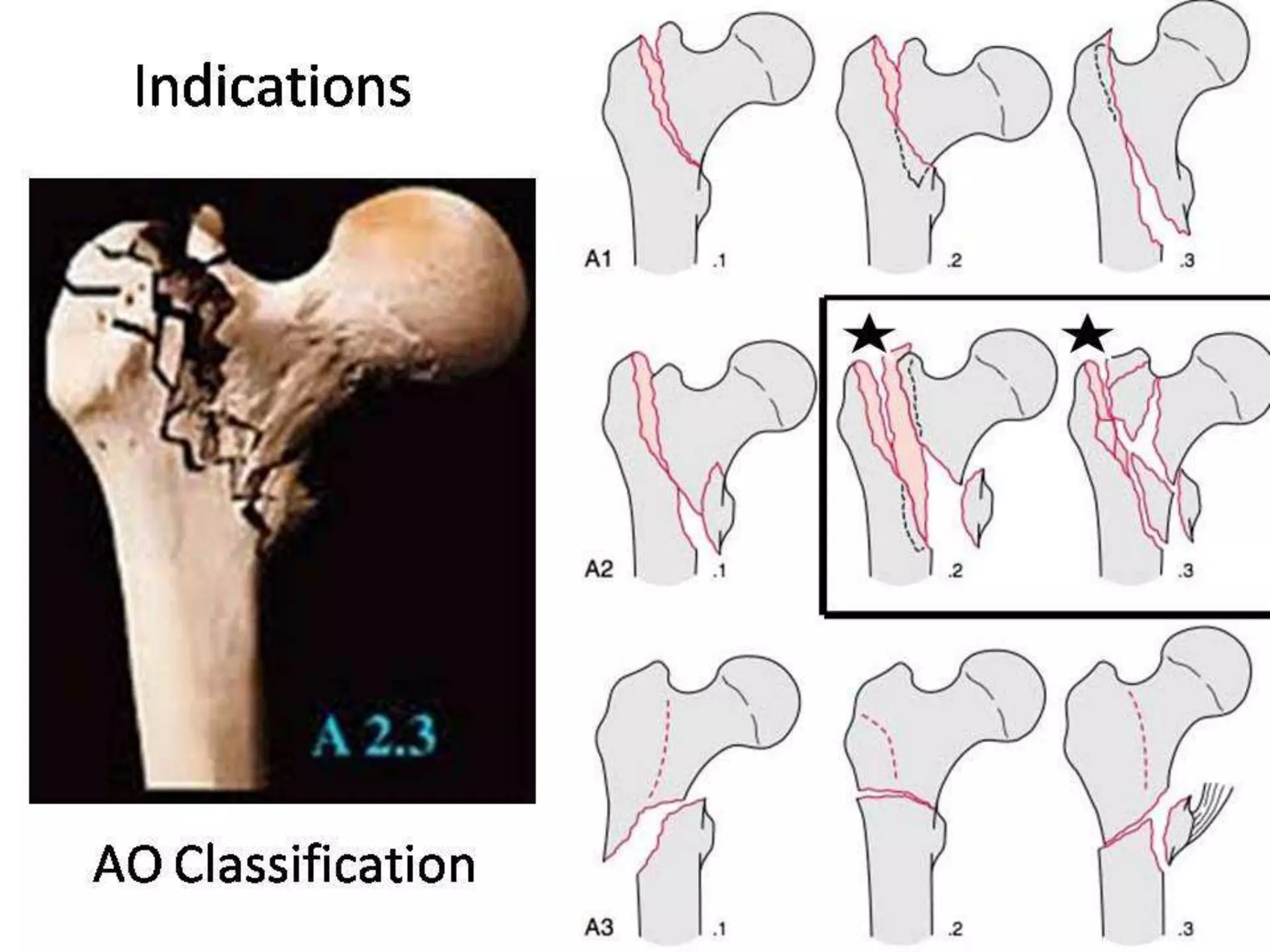 Hemiarthroplasty in Unstable Trochanteric Fractures.pptx