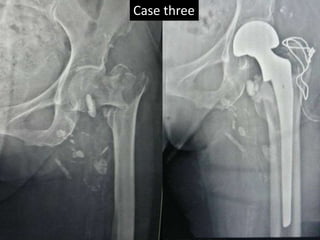 Hemiarthroplasty in Unstable Trochanteric Fractures.pptx