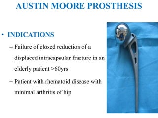 hemiarthroplastyunipolarandbipolarindicationsapproachandprocedure ...