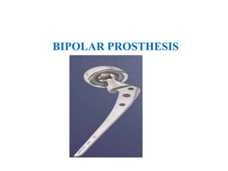 hemiarthroplastyunipolarandbipolarindicationsapproachandprocedure ...