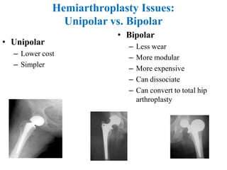 hemiarthroplastyunipolarandbipolarindicationsapproachandprocedure ...