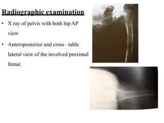 hemiarthroplastyunipolarandbipolarindicationsapproachandprocedure ...