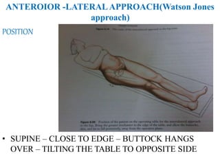 hemiarthroplastyunipolarandbipolarindicationsapproachandprocedure ...