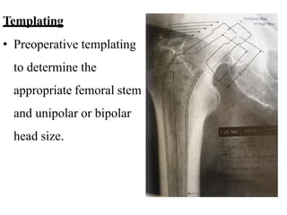 hemiarthroplastyunipolarandbipolarindicationsapproachandprocedure ...