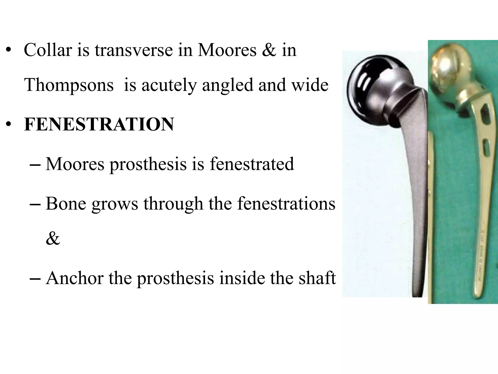 Hemiarthroplasty of Hip joint | PPTX