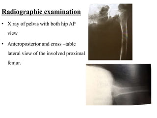 Hemiarthroplasty of Hip joint | PPTX