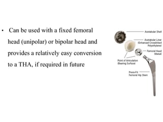 Bipolar Hemiarthroplasty