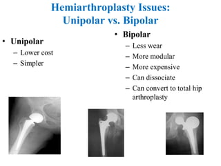 Bipolar Hemiarthroplasty Vs Total Hip Replacement