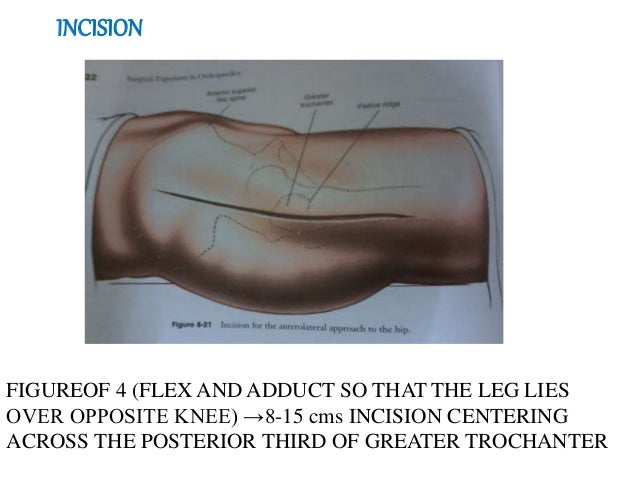 Hemiarthroplasty of Hip joint