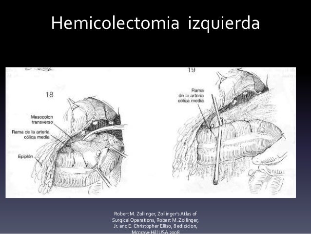 Emicolectomia