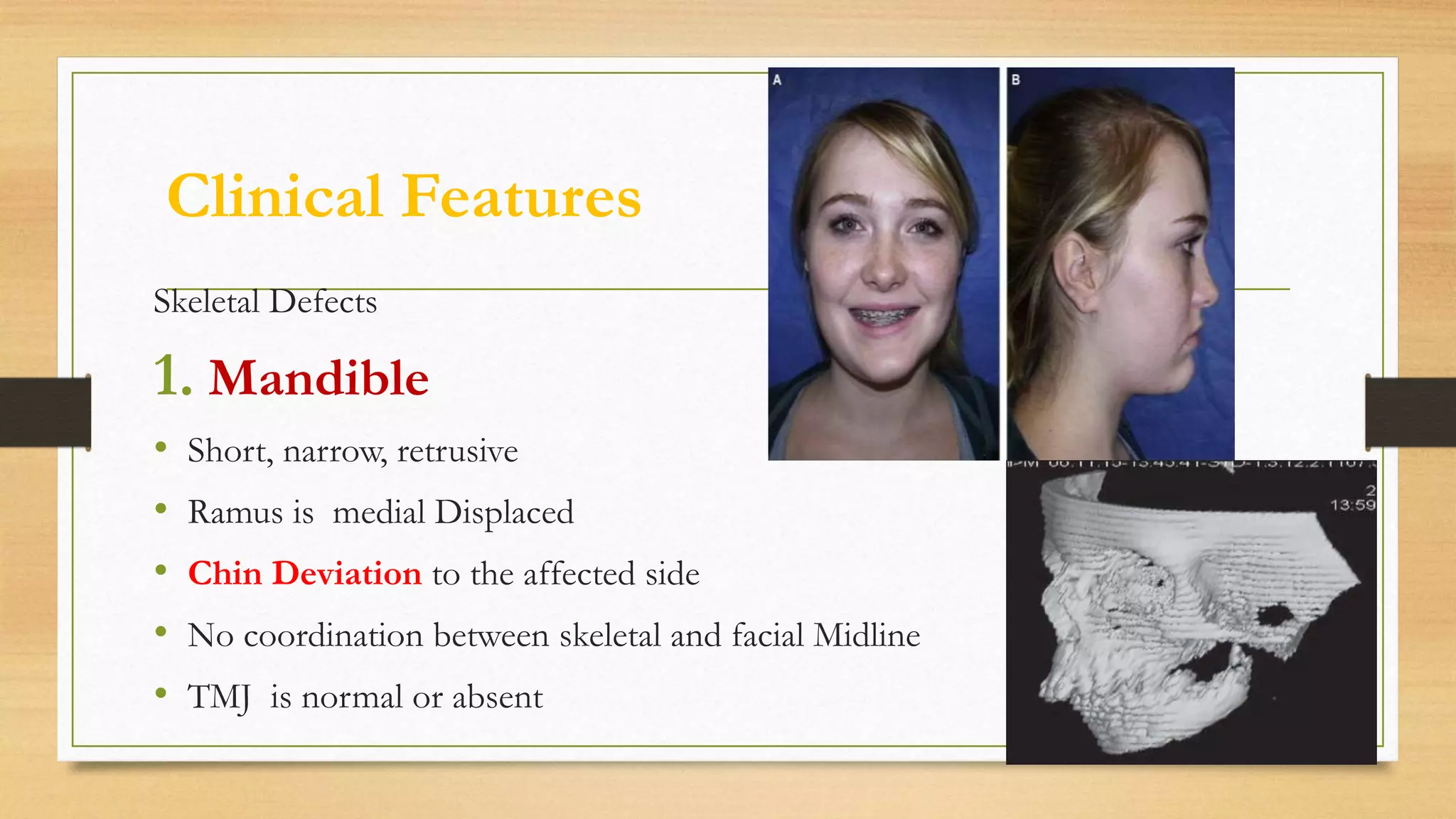 Hemifacial microsomia | PPTX | Ear, Nose and Throat Conditions ...