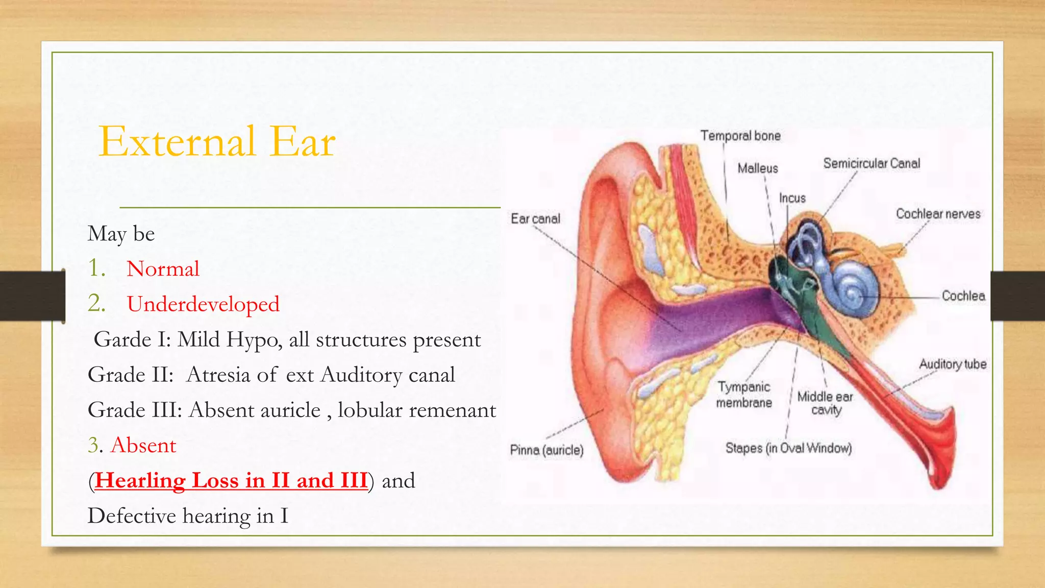 Hemifacial microsomia | PPTX