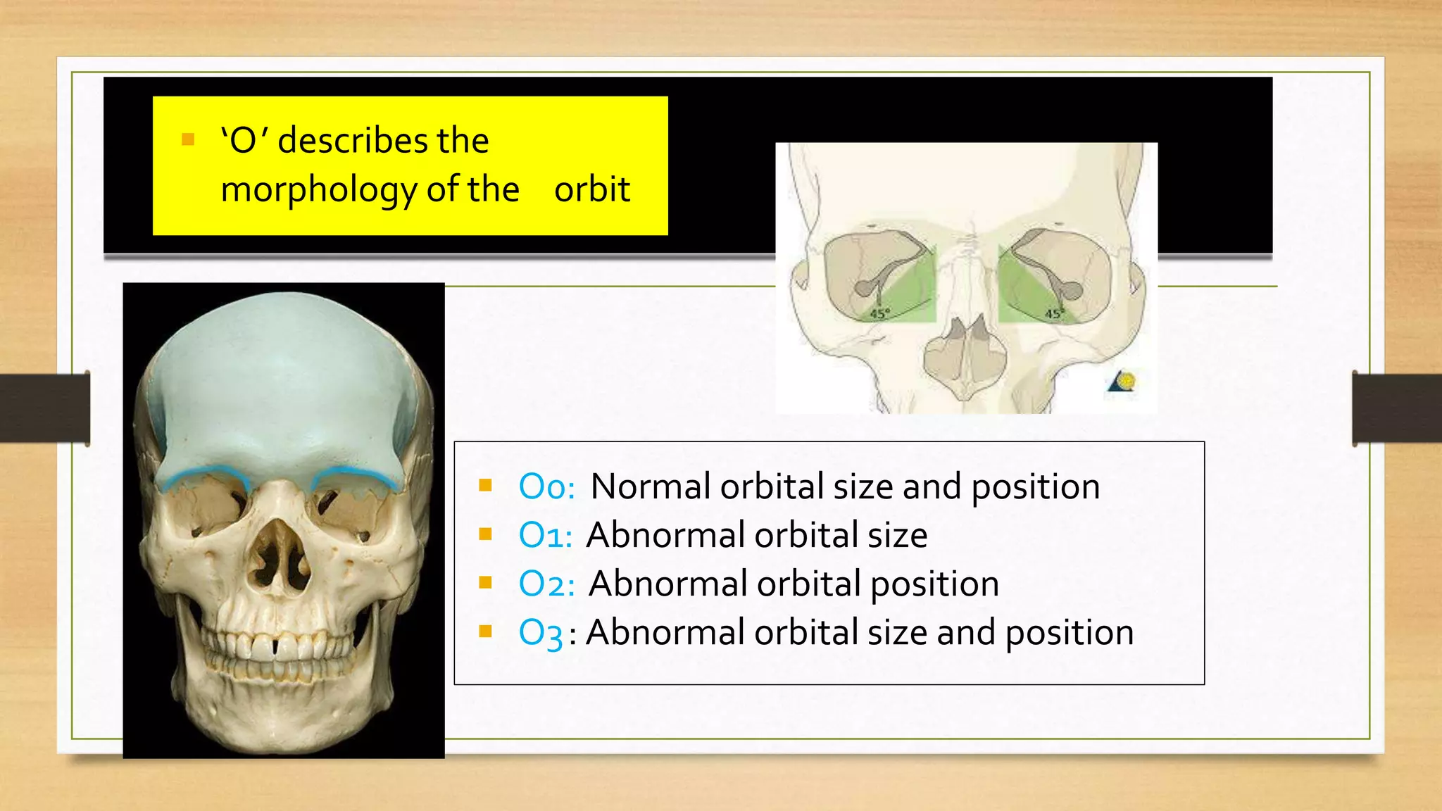 Hemifacial microsomia | PPTX