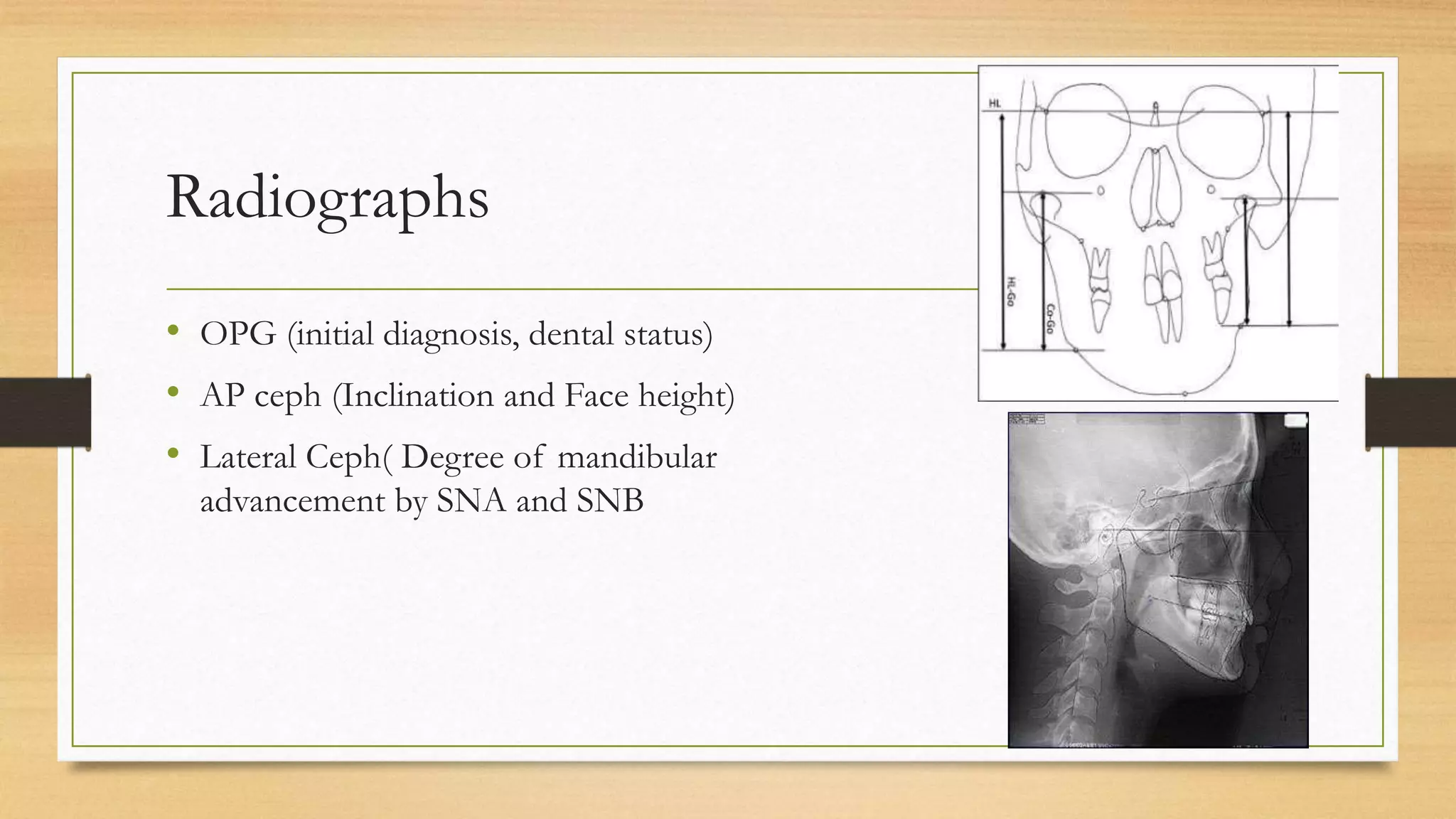 Hemifacial microsomia | PPTX