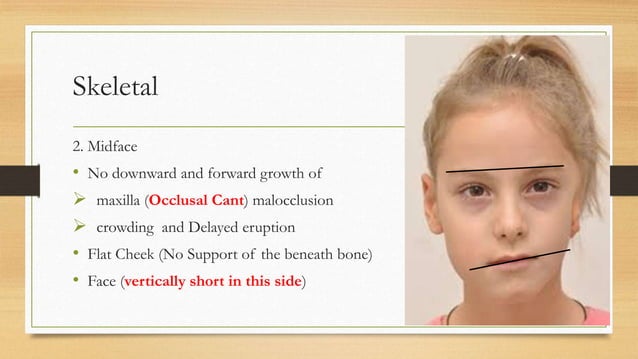 Hemifacial microsomia | PPTX | Ear, Nose and Throat Conditions ...