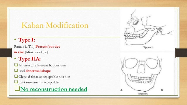 Hemifacial microsomia