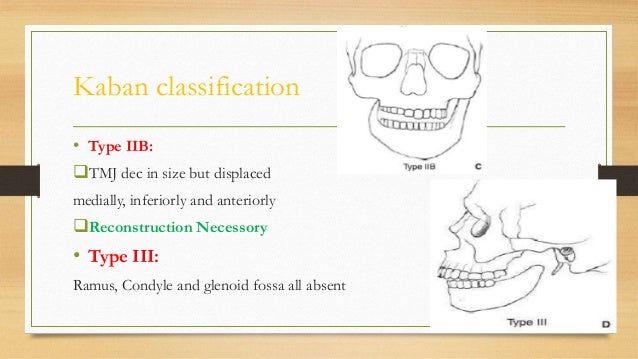Hemifacial microsomia
