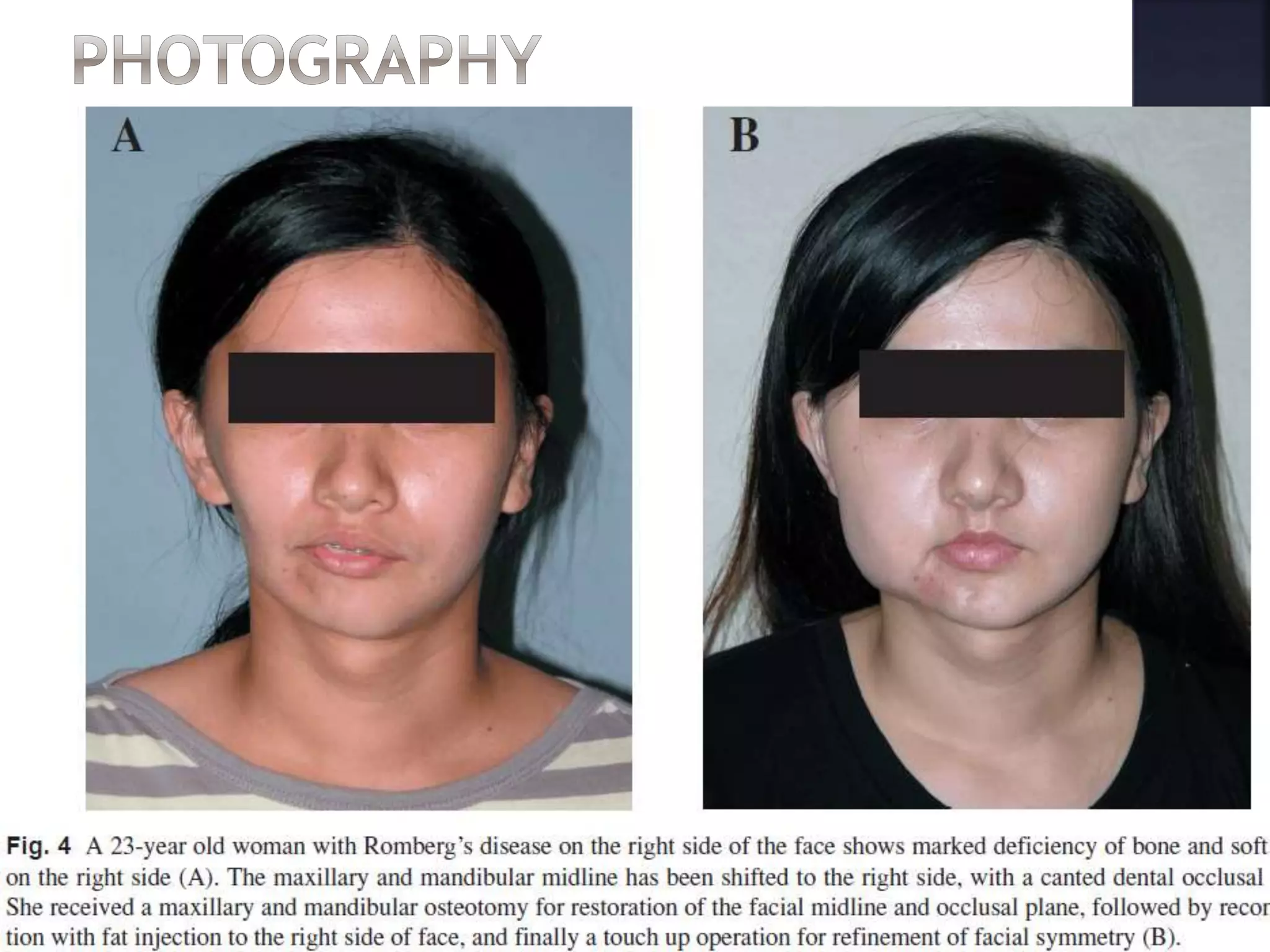 Hemifacial microsomia2.1 | PPTX