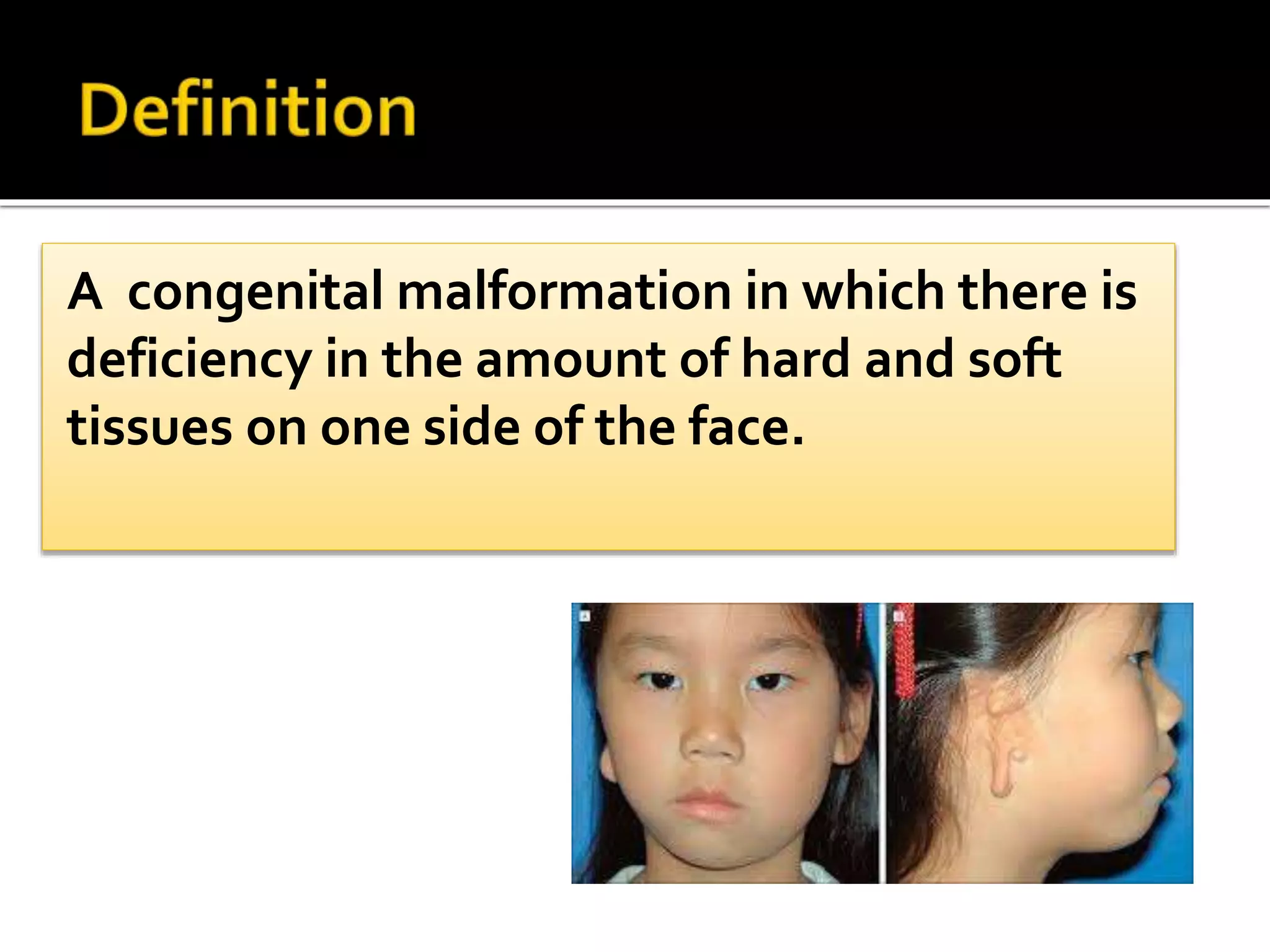 HEMIFACIAL MICROSOMIA DR VIPIN V NAIR | PPTX
