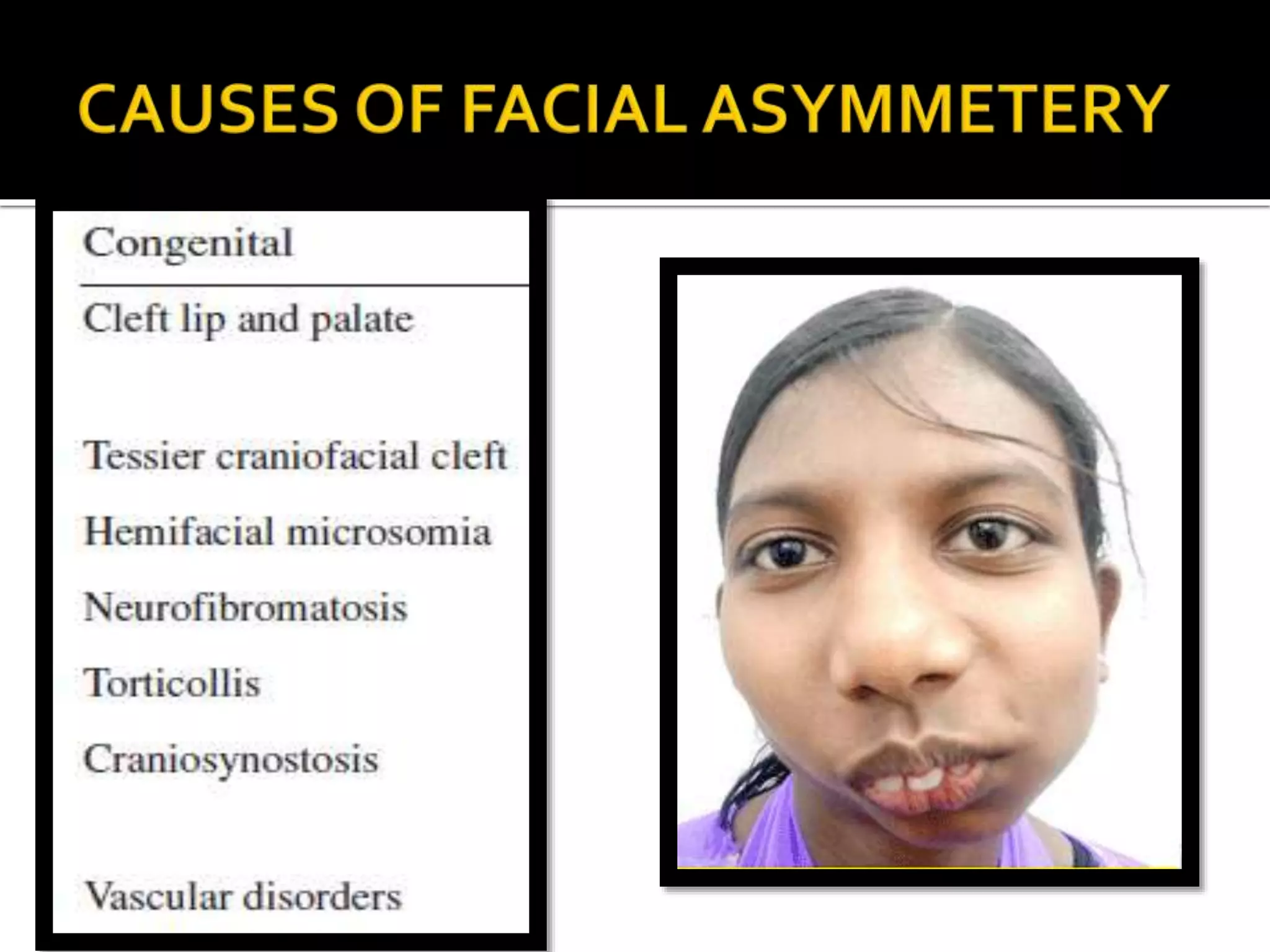 HEMIFACIAL MICROSOMIA DR VIPIN V NAIR | PPTX