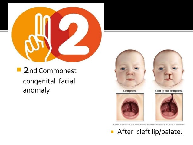 HEMIFACIAL MICROSOMIA DR VIPIN V NAIR | PPTX | Ear, Nose and Throat ...