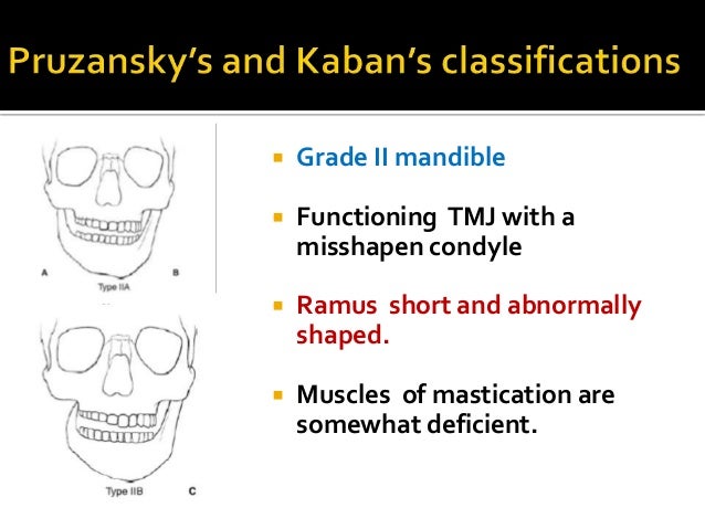 HEMIFACIAL MICROSOMIA DR VIPIN V NAIR