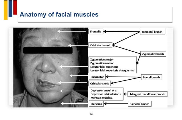 Hemifacial spasm