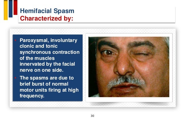 Hemifacial spasm