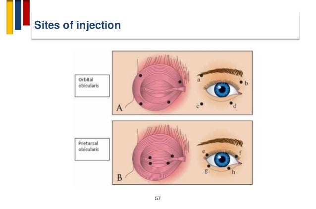 Hemifacial spasm