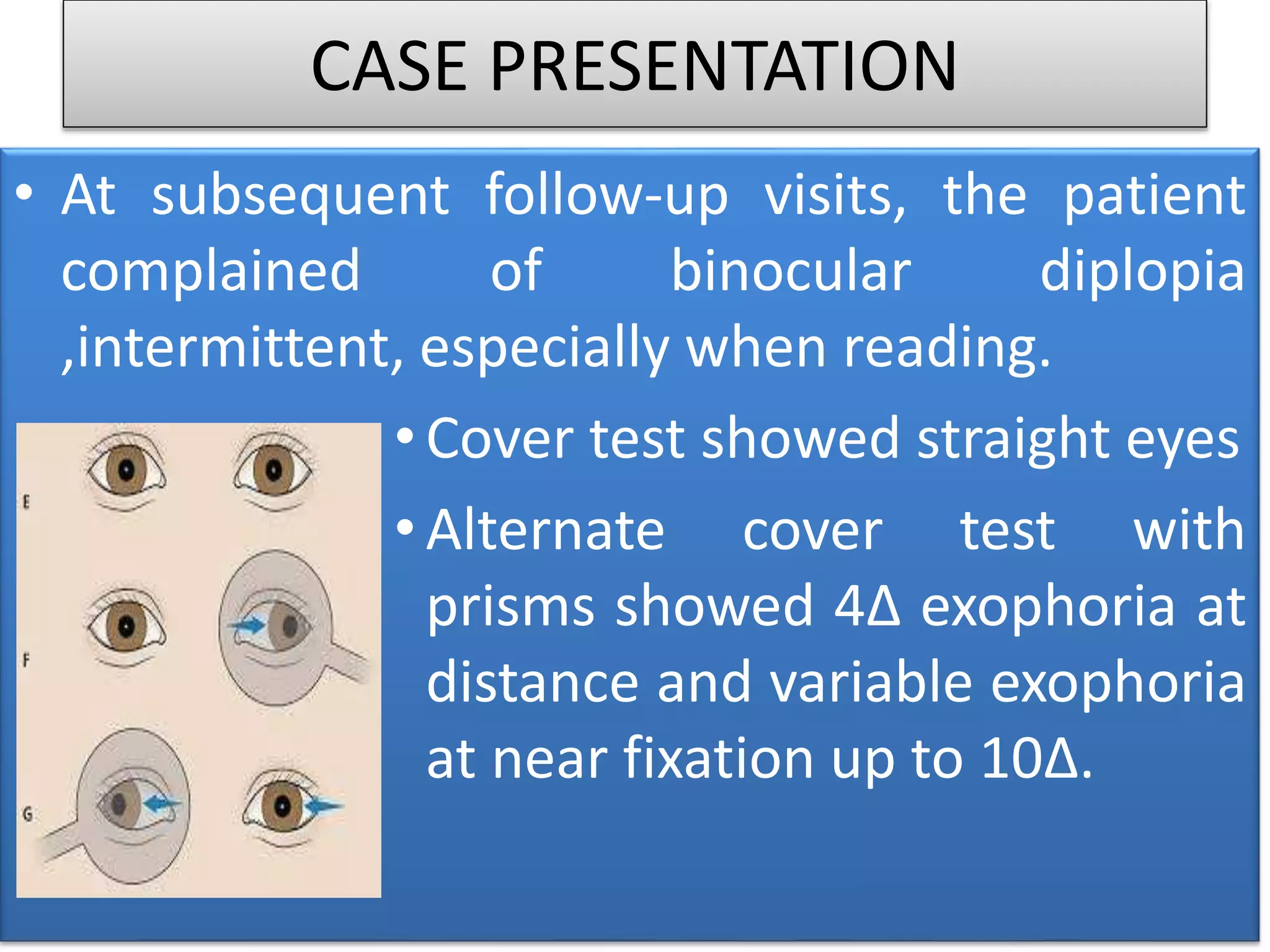 Hemifeild sliding phenomenon | PPTX