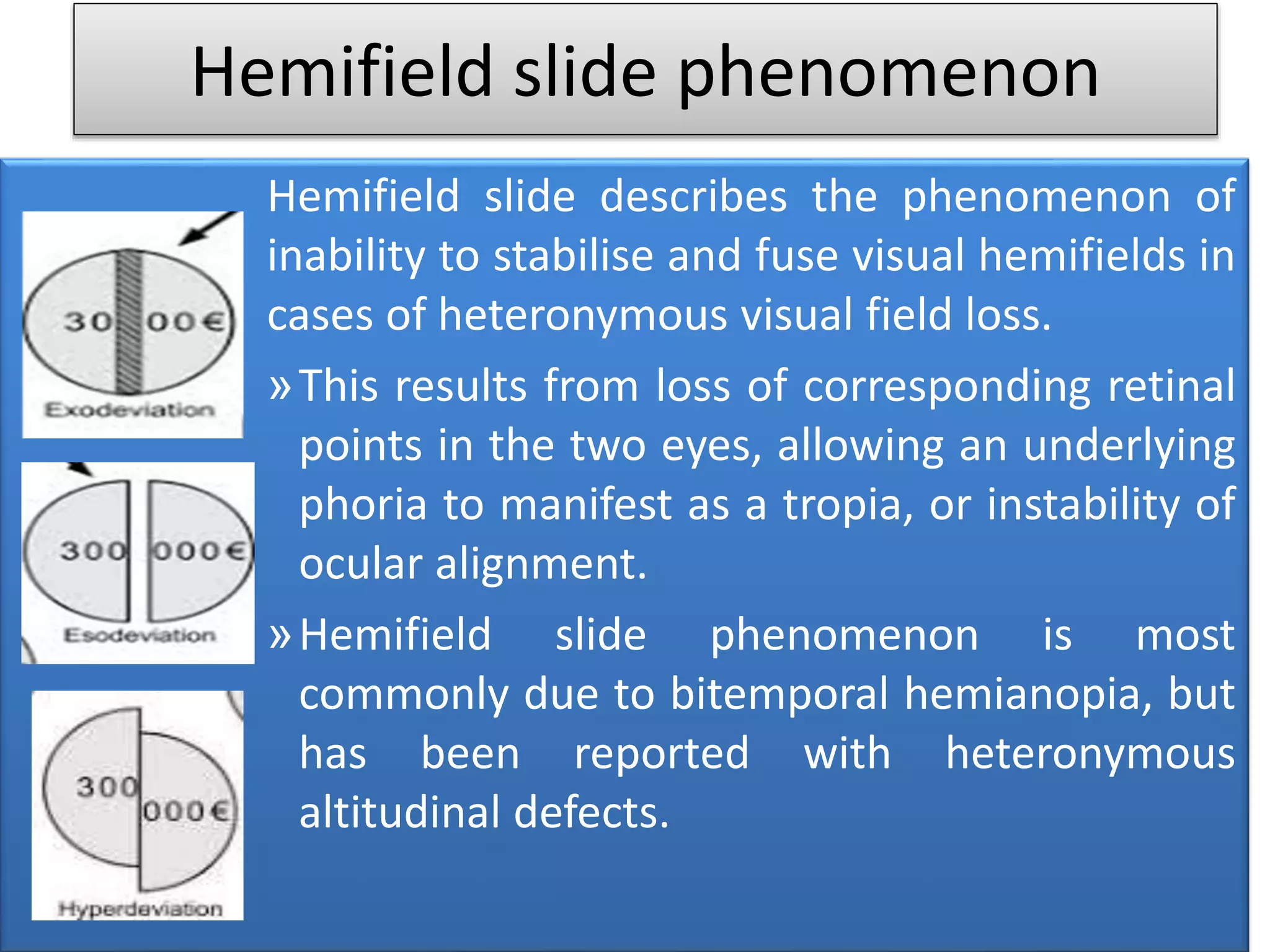 Hemifeild sliding phenomenon | PPTX