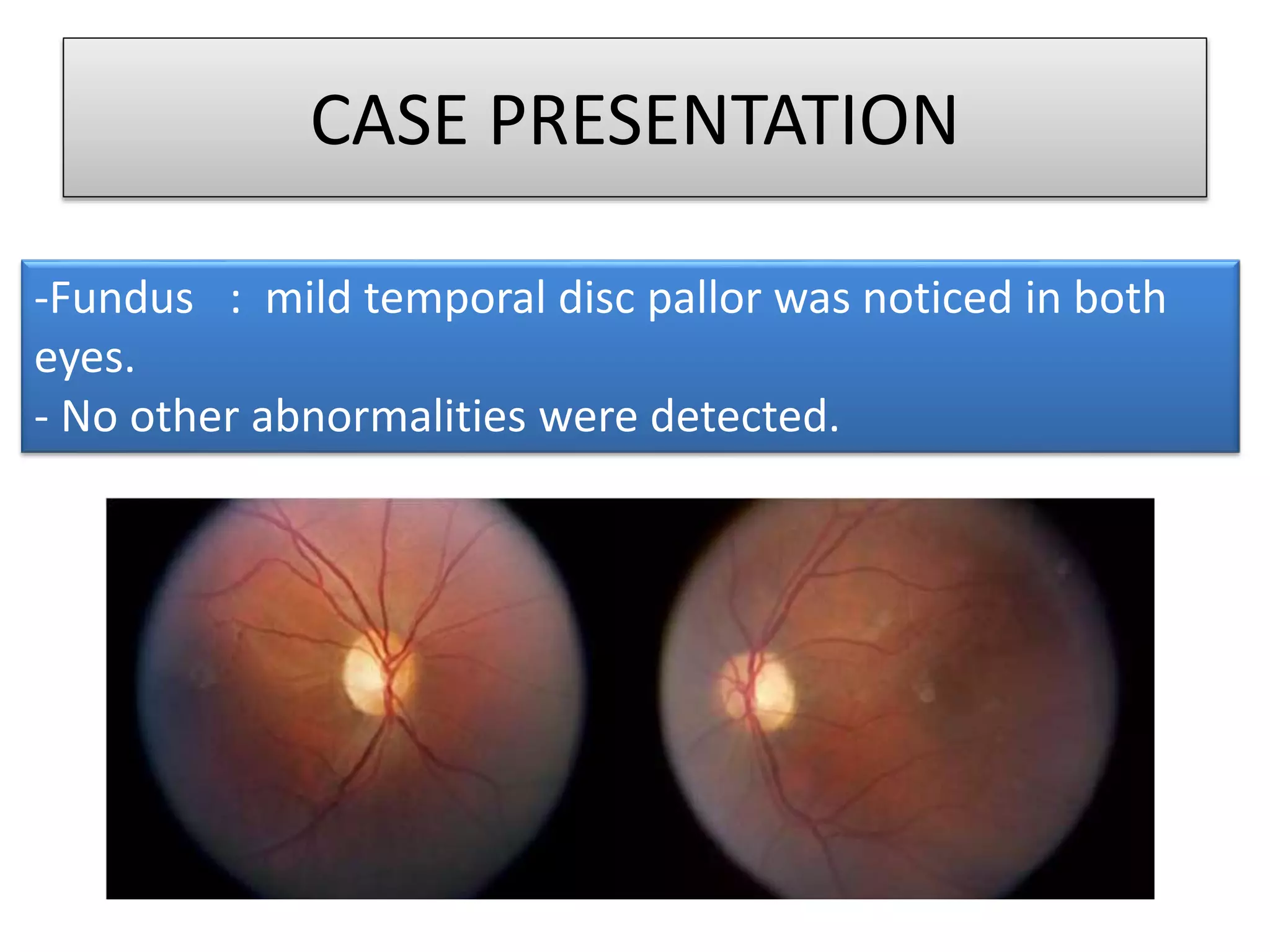 Hemifeild sliding phenomenon | PPTX