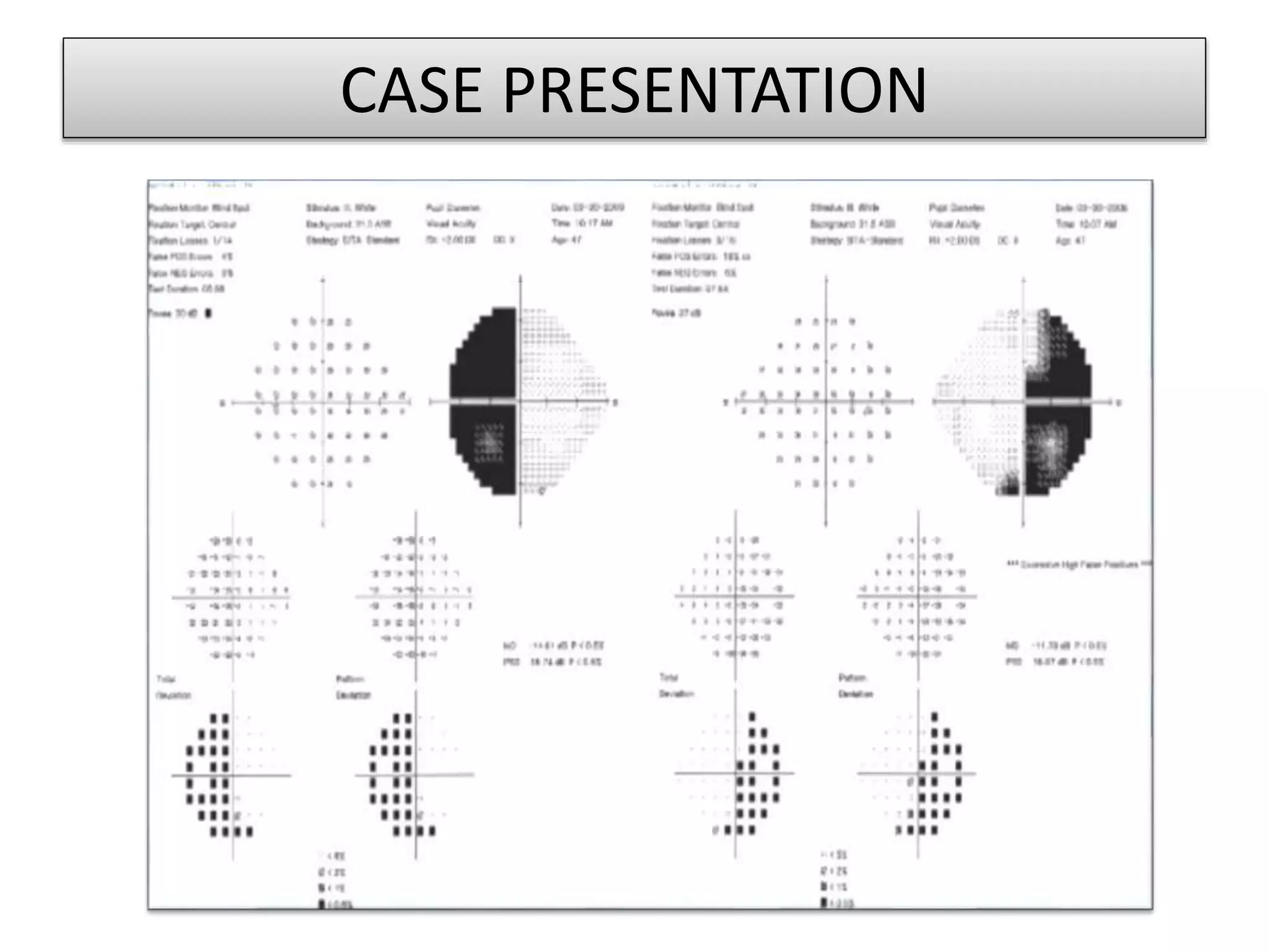Hemifeild sliding phenomenon | PPTX