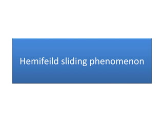 Hemifeild sliding phenomenon | PPTX