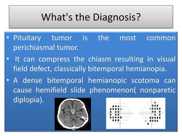 Hemifeild sliding phenomenon | PPTX | Endocrine and Metabolic Diseases ...