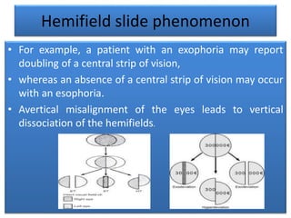 Hemifeild sliding phenomenon | PPTX