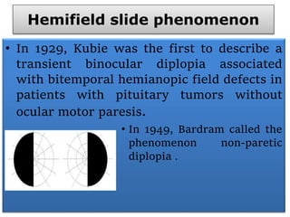 Hemifeild sliding phenomenon | PPTX
