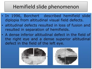 Hemifeild sliding phenomenon | PPTX