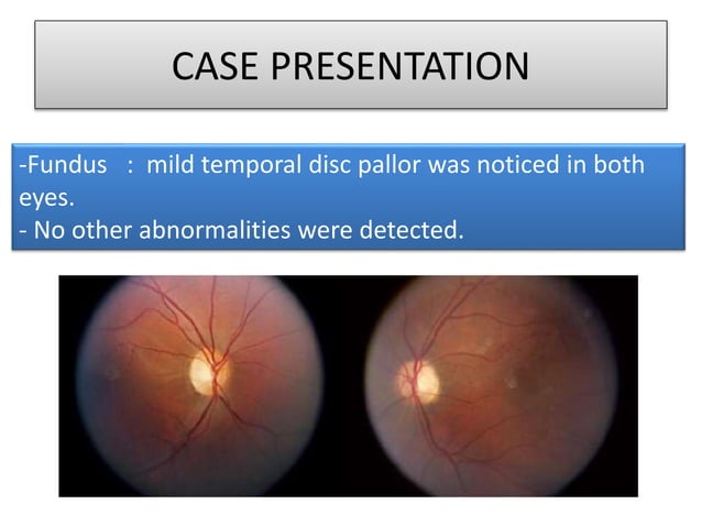 Hemifeild sliding phenomenon | PPTX | Endocrine and Metabolic Diseases ...