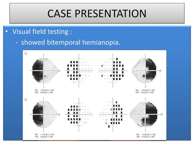 Hemifeild sliding phenomenon | PPTX | Endocrine and Metabolic Diseases ...