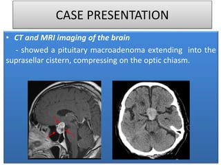 Hemifeild sliding phenomenon | PPTX