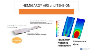 HEMIGARD ARS Device - Close More Wounds, More Simply | PPT