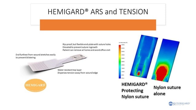 HEMIGARD ARS Device - Close More Wounds, More Simply | PPT
