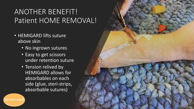 HEMIGARD ARS Device - Close More Wounds, More Simply | PPT | Free Download